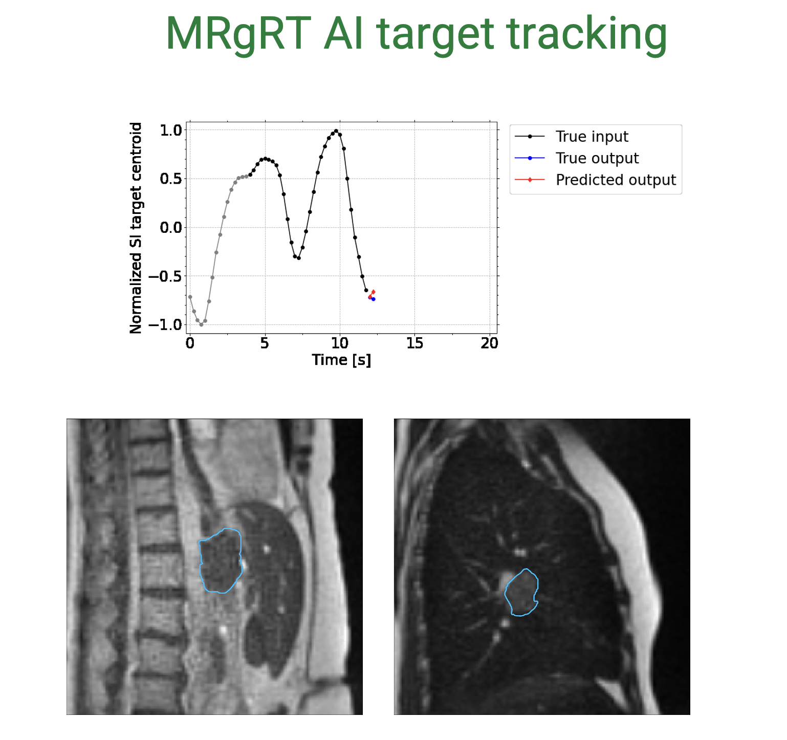 MRgRT AI-based Target Tracking | LMU ART Lab